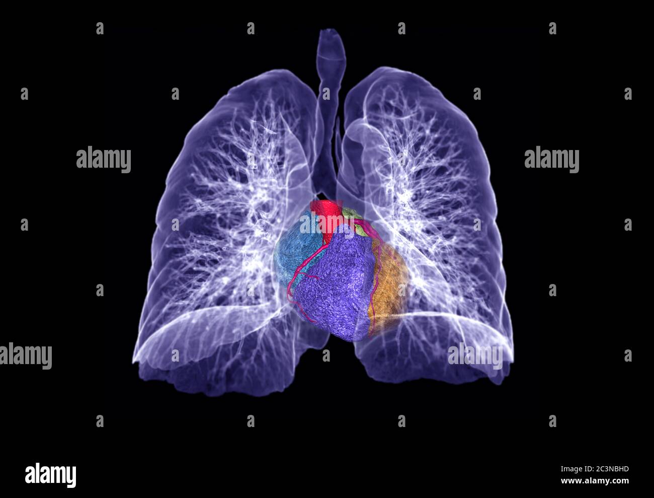 CT Chest or Lung 3D rendering image with 3D heart for diagnosis TB,tuberculosis and covid-19 ...