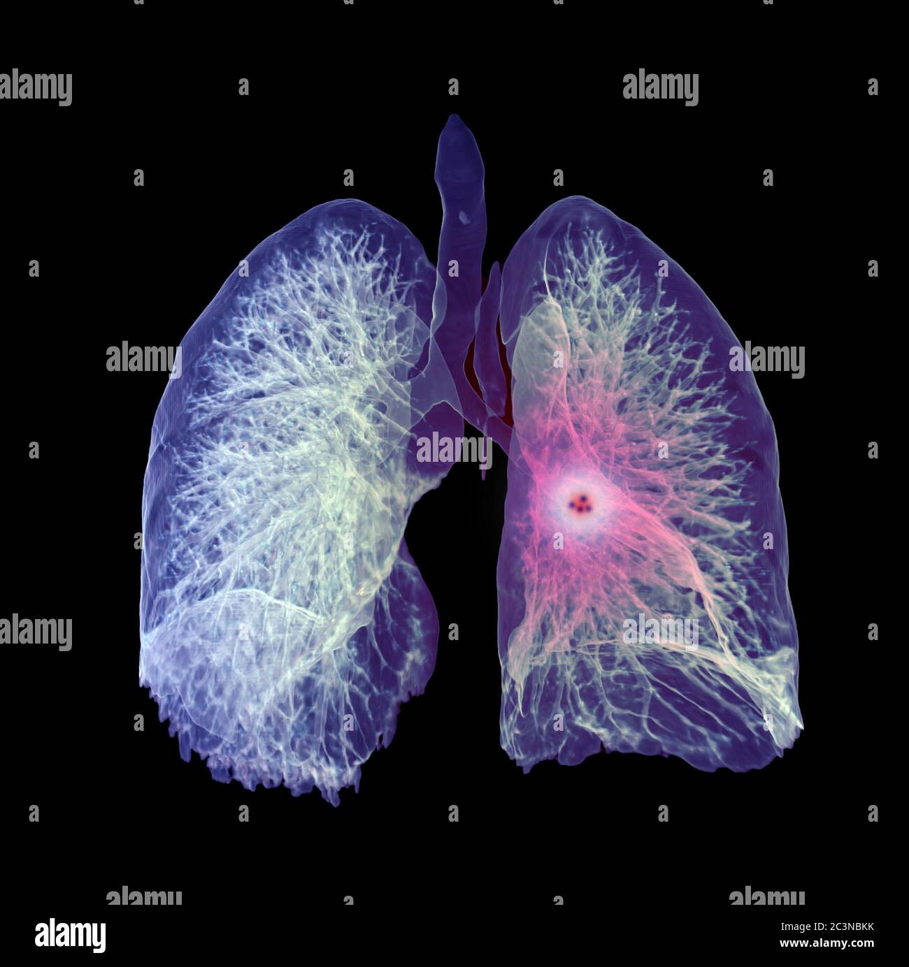 CT Chest or Lung 3D rendering image for diagnosis TB,tuberculosis and covid-19 Stock Photo - Alamy