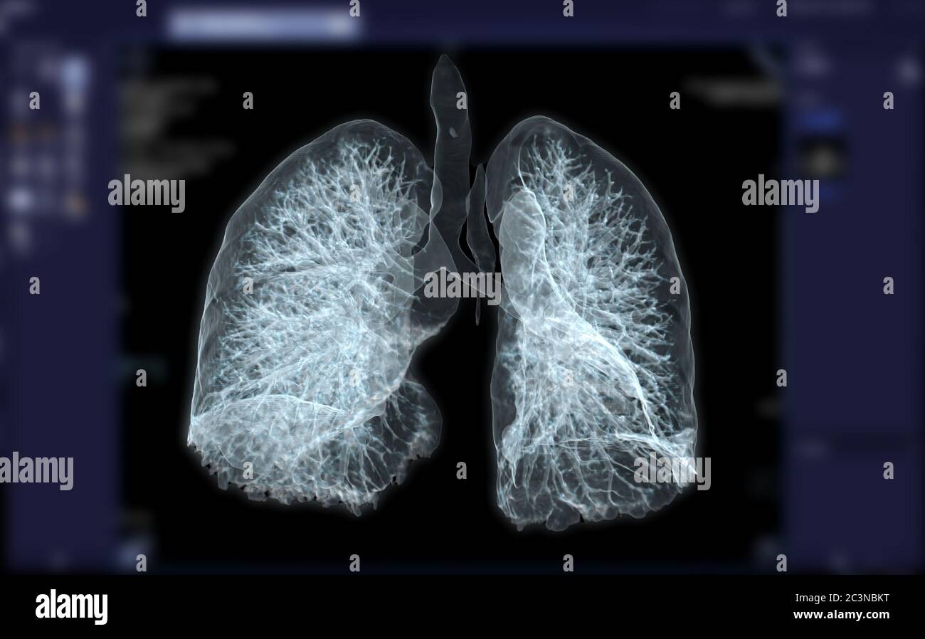 CT Chest or Lung 3D rendering image for diagnosis TB,tuberculosis and covid-19 Stock Photo - Alamy