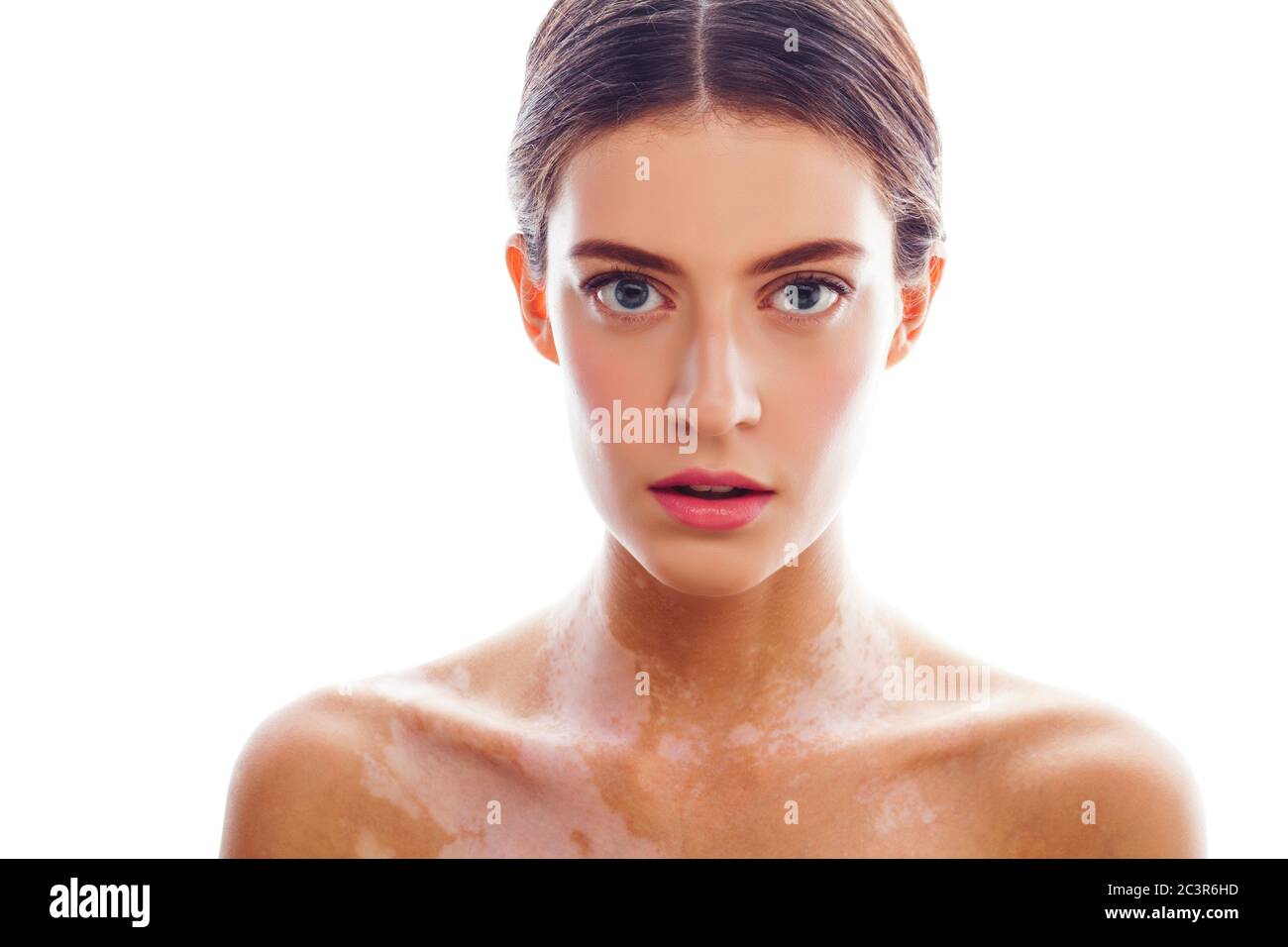 beautiful young brunette woman with vitiligo disease isolated on white ...