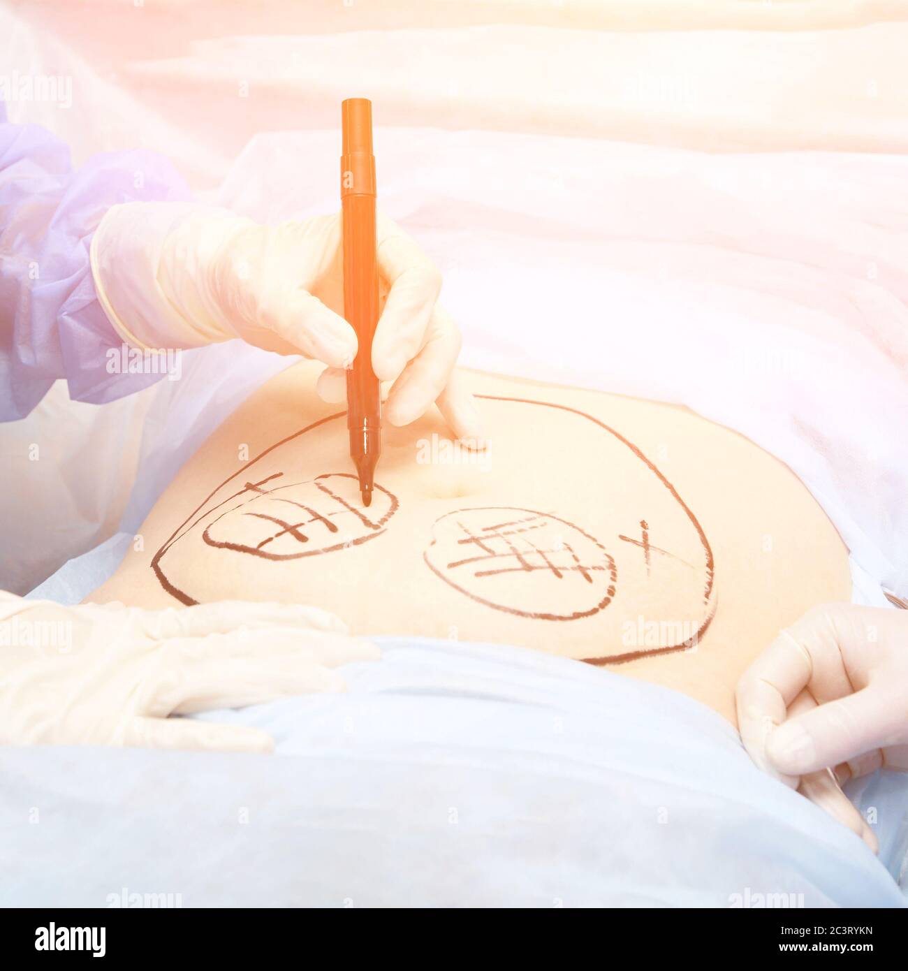 Plastic surgery woman belly hi-res stock photography and images - Alamy