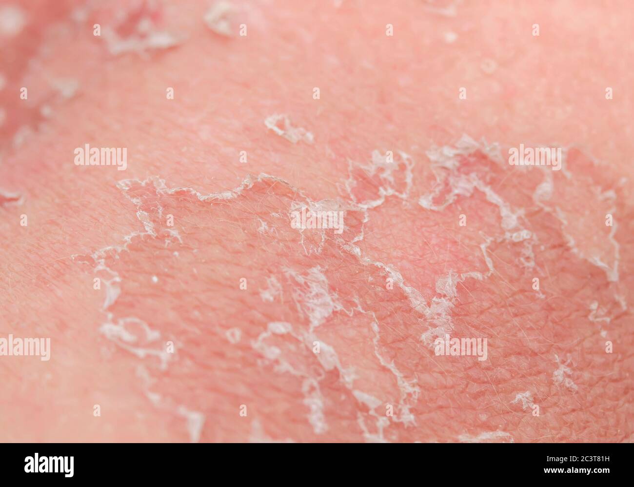 background with texture of irritated skin with cracks of dead cells and ...