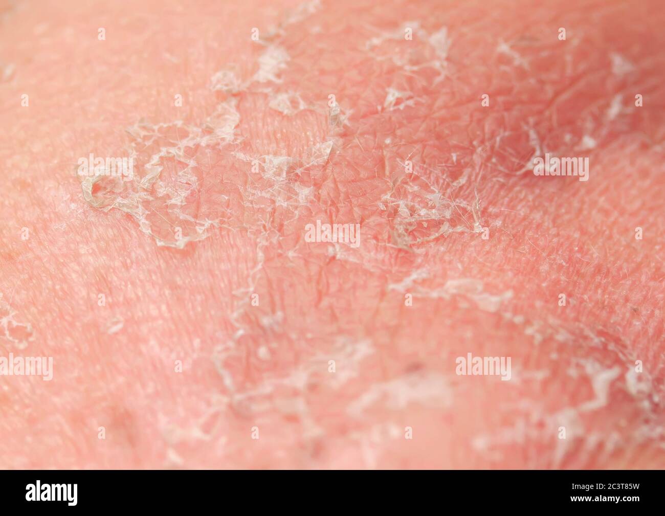 background with texture of irritated skin with cracks of dead cells and ...
