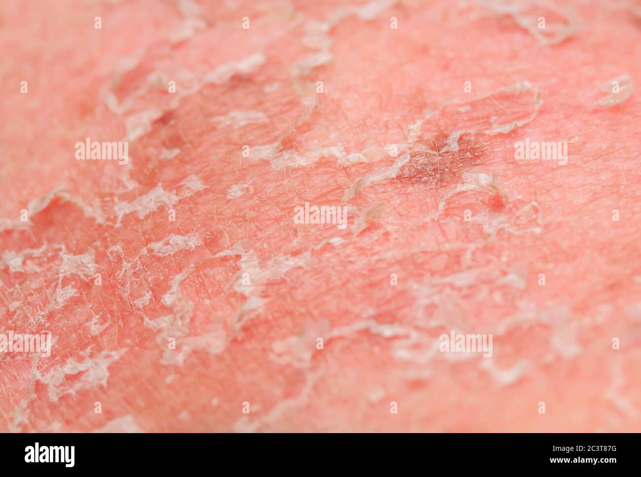 background with the texture of irritated reddened skin with flaking ...