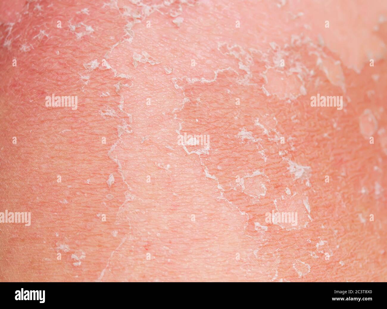 Texture Of Irritated Reddened Skin With Flaking Scales Of Dead Old
