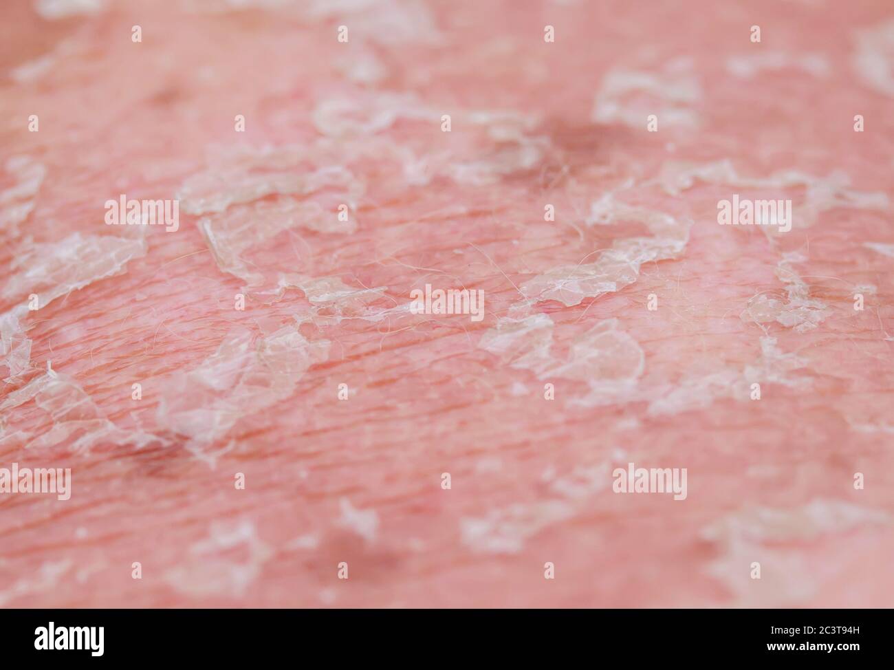 textured background with scales of dead skin cells with redness and ...