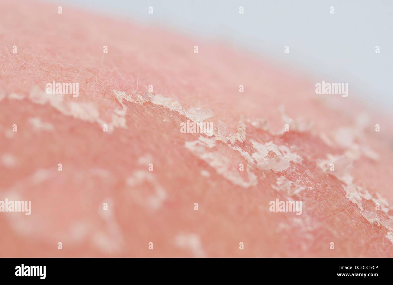 Texture Of Irritated Reddened Skin With Flaking Scales And Cracks From