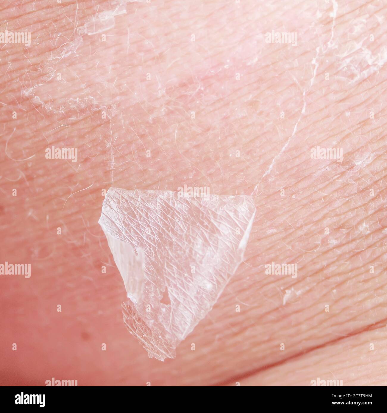 square background with flakes of irritated skin covered with cracks ...