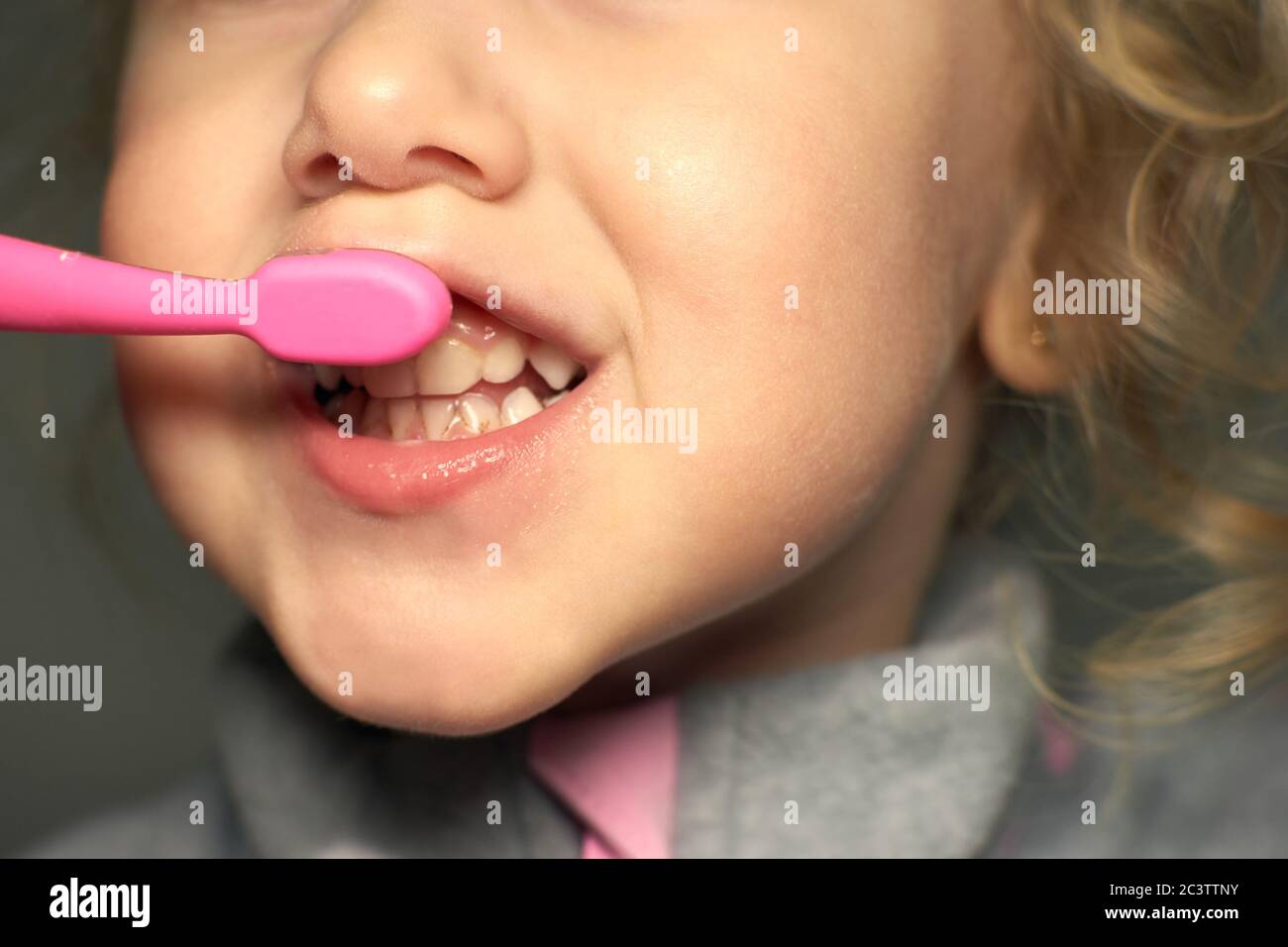 Close up of unhealthy baby teeth. Girl open mouth showing caries teeth ...