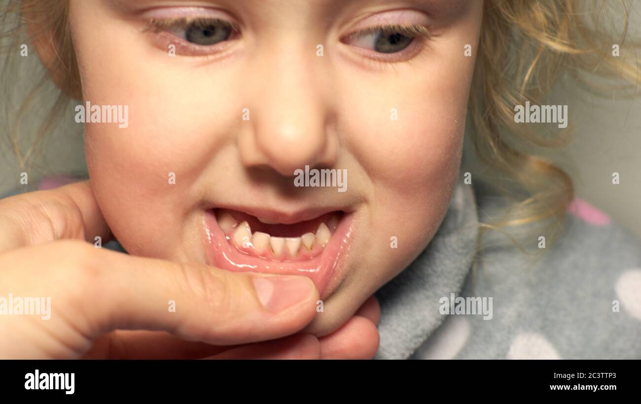 Close up of unhealthy baby teeth. Girl open mouth showing caries teeth ...