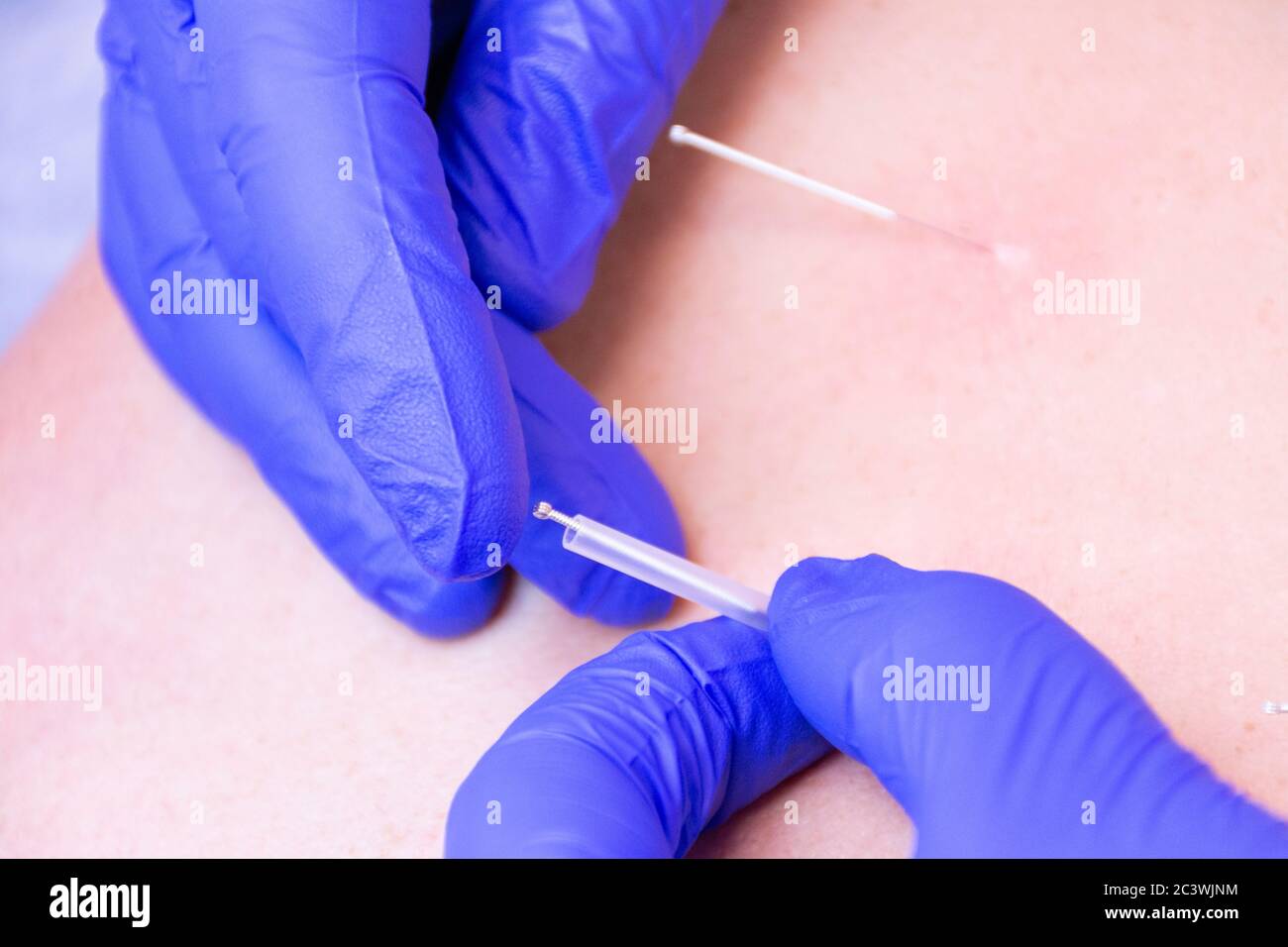 Hands in white gloves placing an acupuncture needle on a woman's back ...