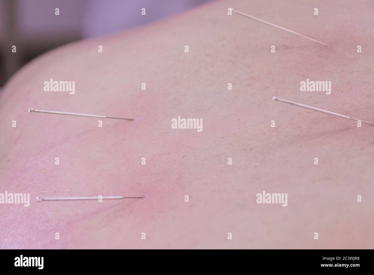 Back of an unrecognizable woman with four acupuncture needles on her ...