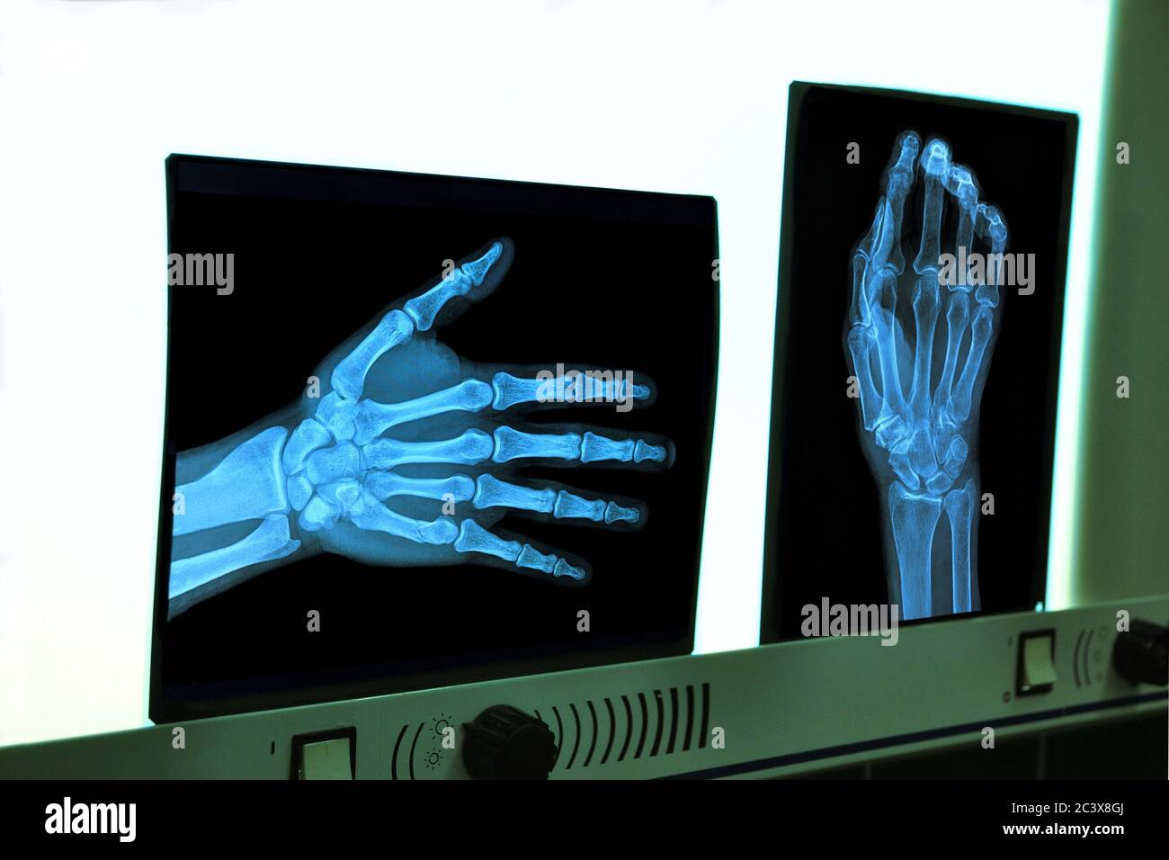 negatoscope with xray of hand Stock Photo - Alamy