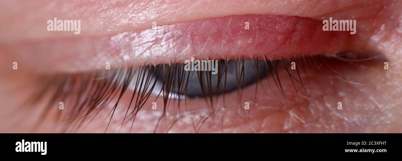 Eyelid lesion hi-res stock photography and images - Alamy