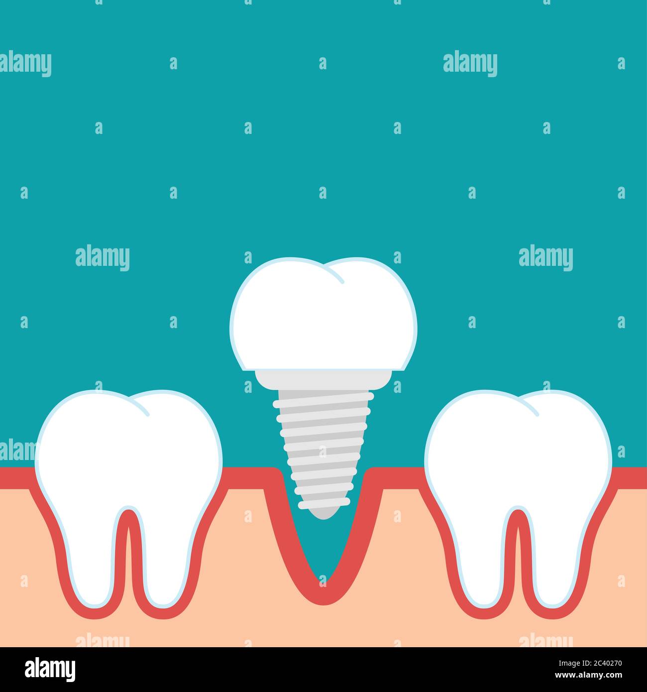 Dental implant flat vector Stock Vector Image & Art - Alamy