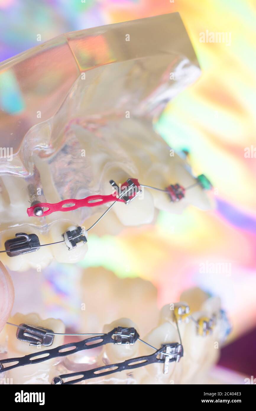 Modern metal retainers and plastic algners wire dental brackets teeth ...