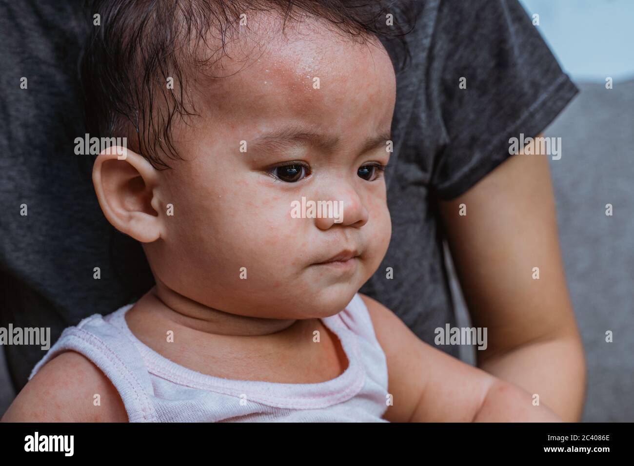 Pityriasis rosea rash hi-res stock photography and images - Alamy