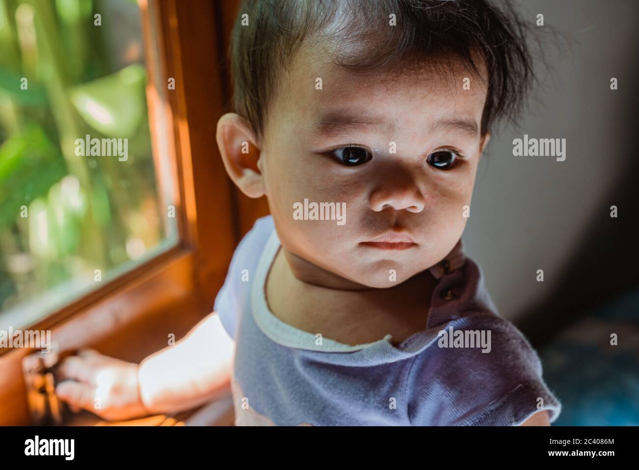 portrait of asian baby with skin rashes from allergies or irritation ...