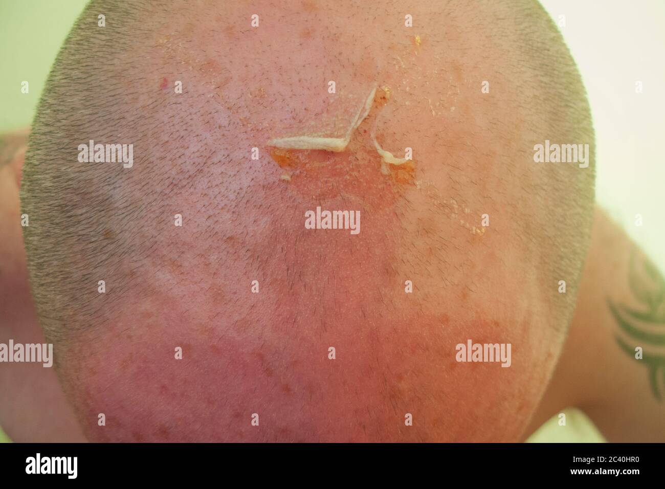 injury to head of bald man Stock Photo - Alamy