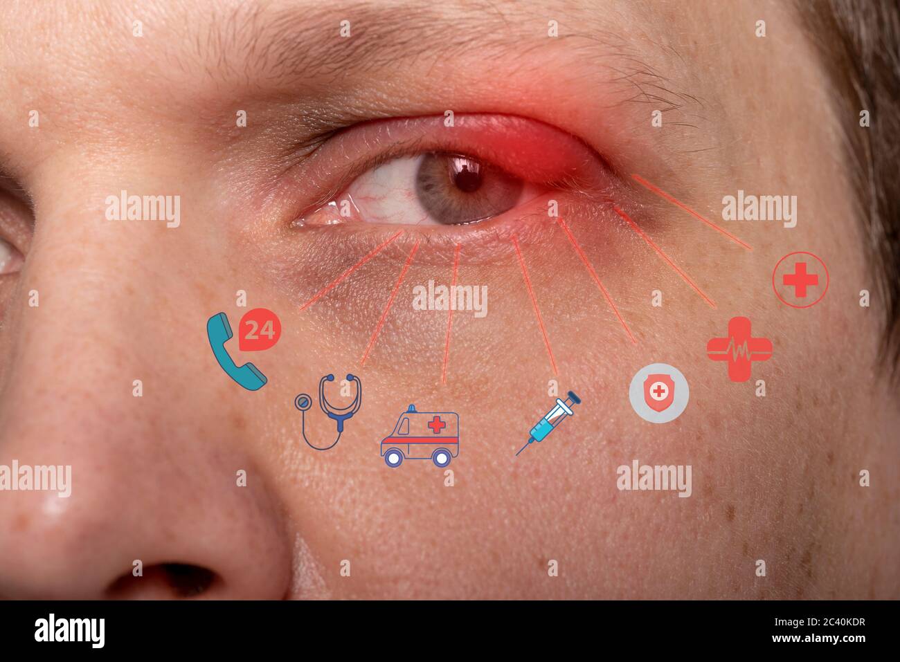Meibomian gland hi-res stock photography and images - Alamy