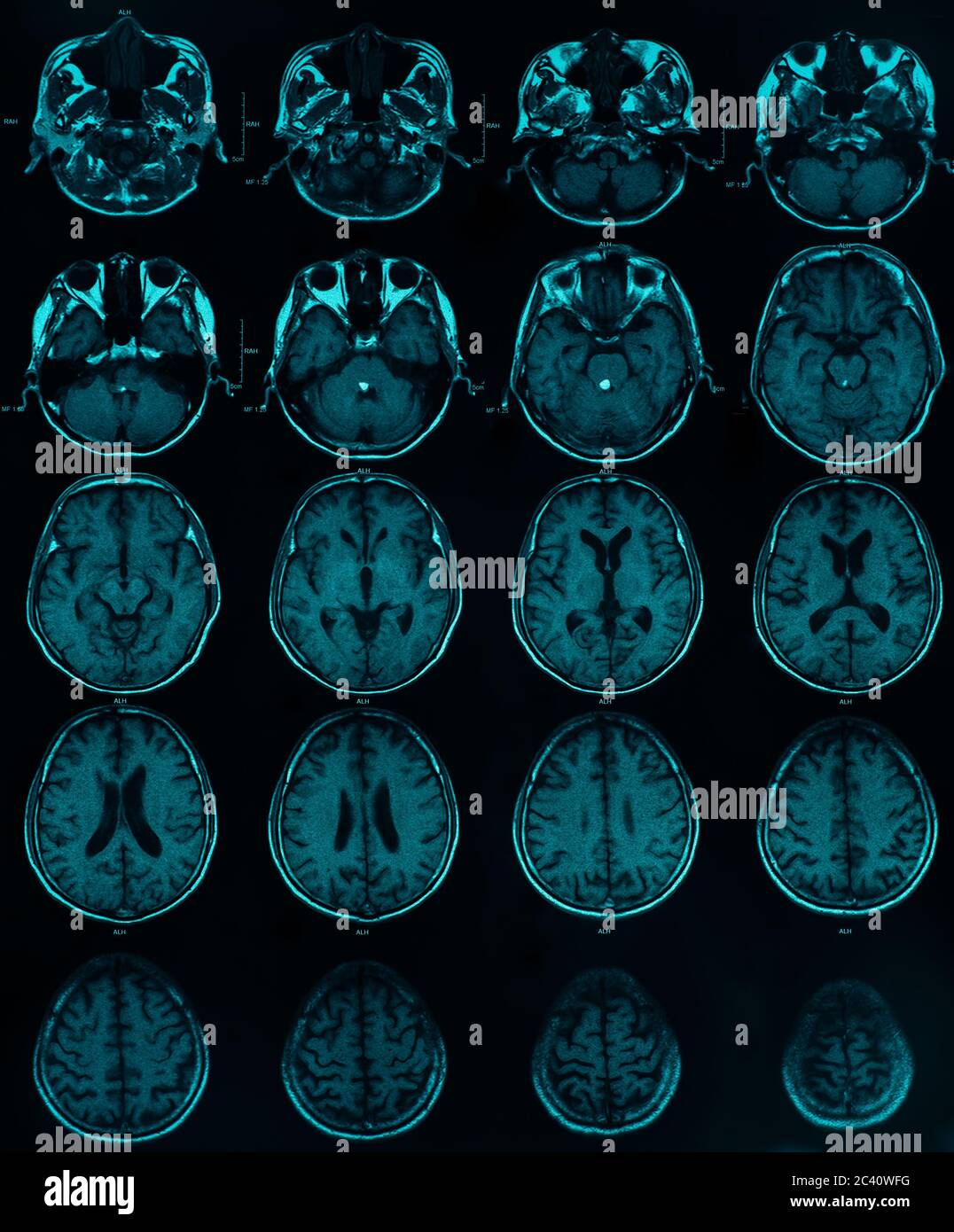 image of CT/MRI brain in blue tone Stock Photo - Alamy