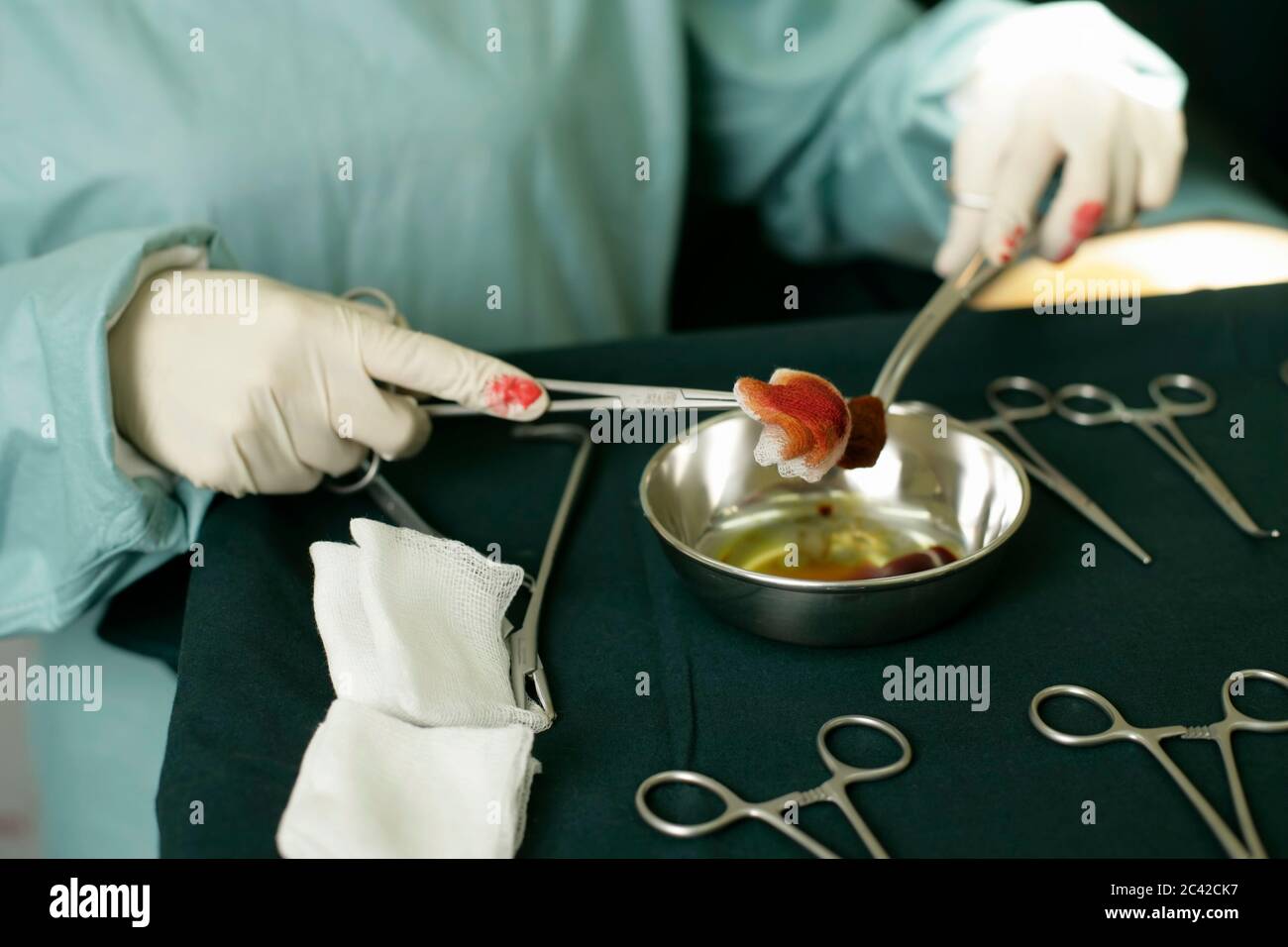 Doctor in sterile clothing with a tissue sample - surgery Stock Photo ...