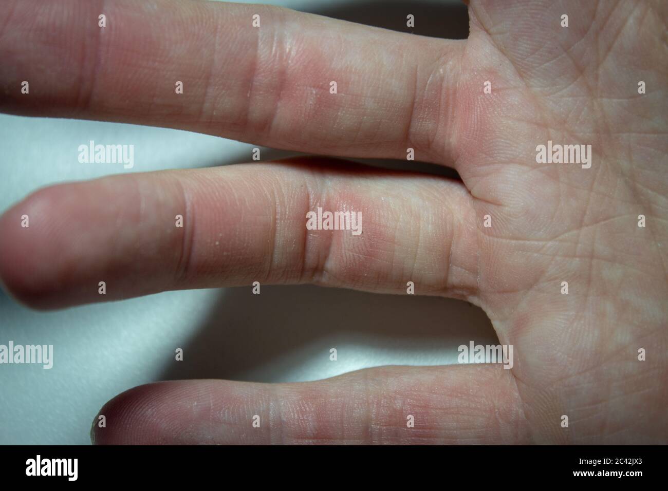 Callus finger hi-res stock photography and images - Alamy
