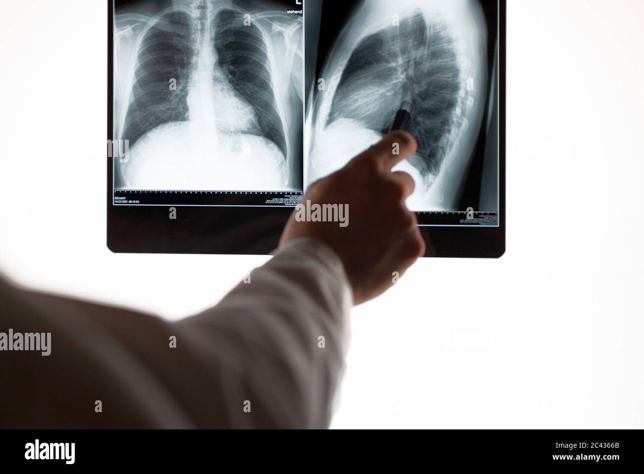 Person points to an x-ray Stock Photo - Alamy