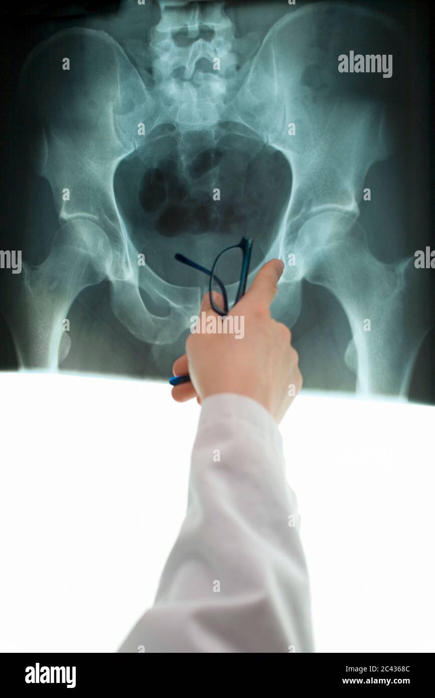 A person points to an x-ray Stock Photo - Alamy