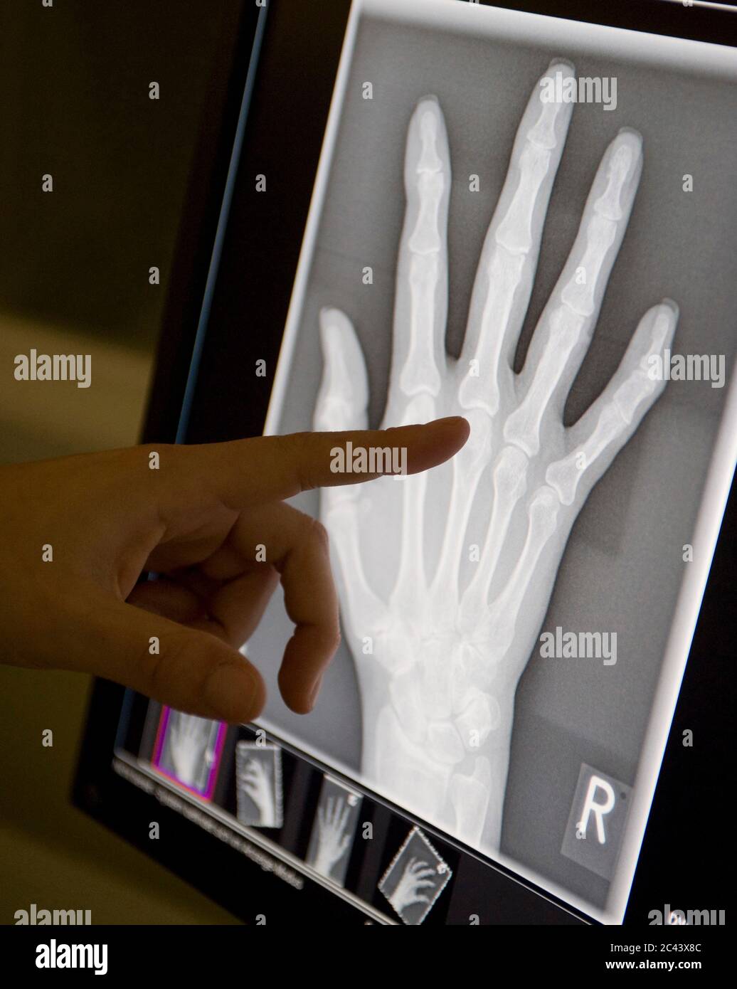 Hand shows on x-ray picture of a hand Stock Photo - Alamy
