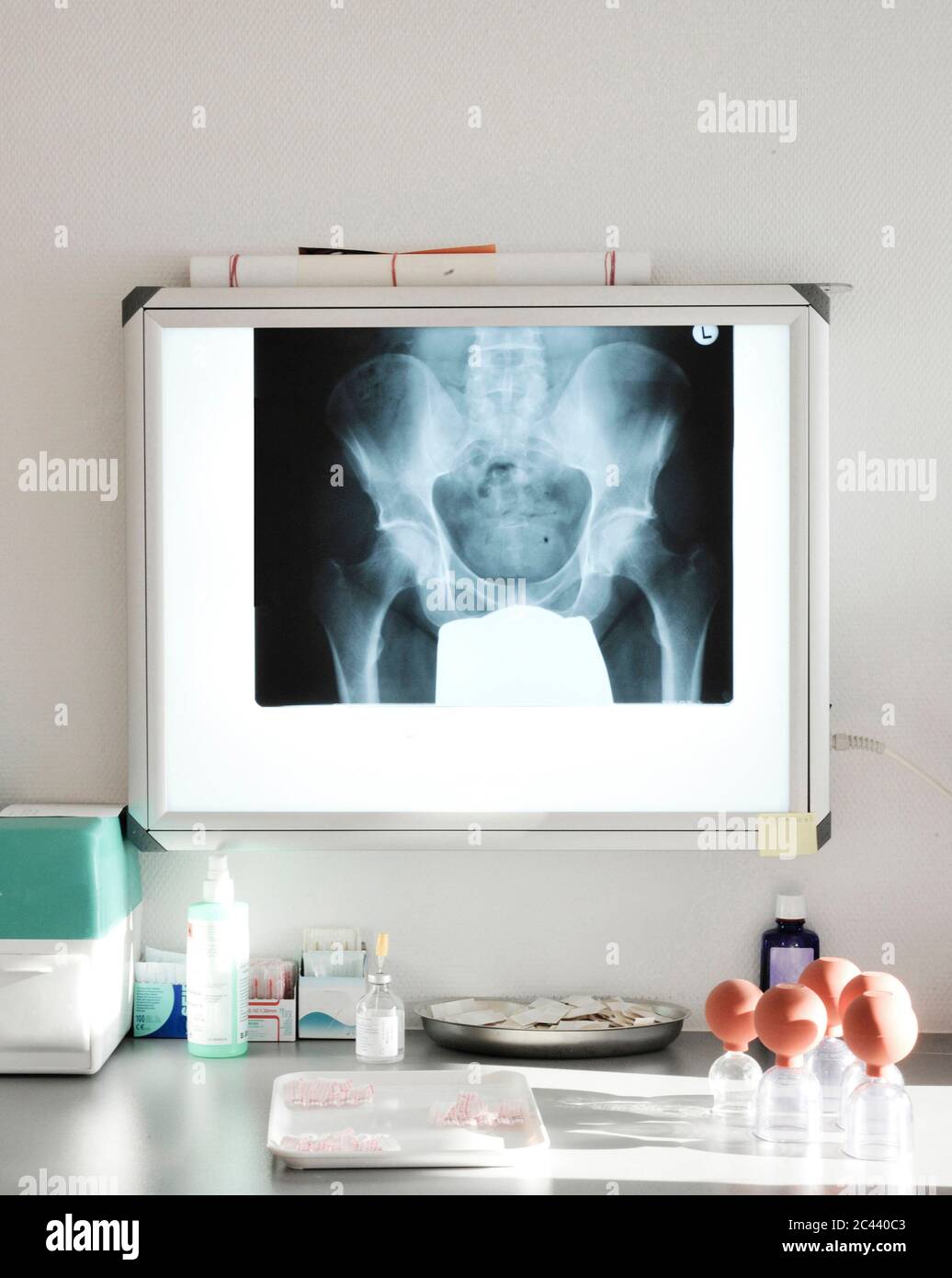 X-ray image of a hip Stock Photo - Alamy