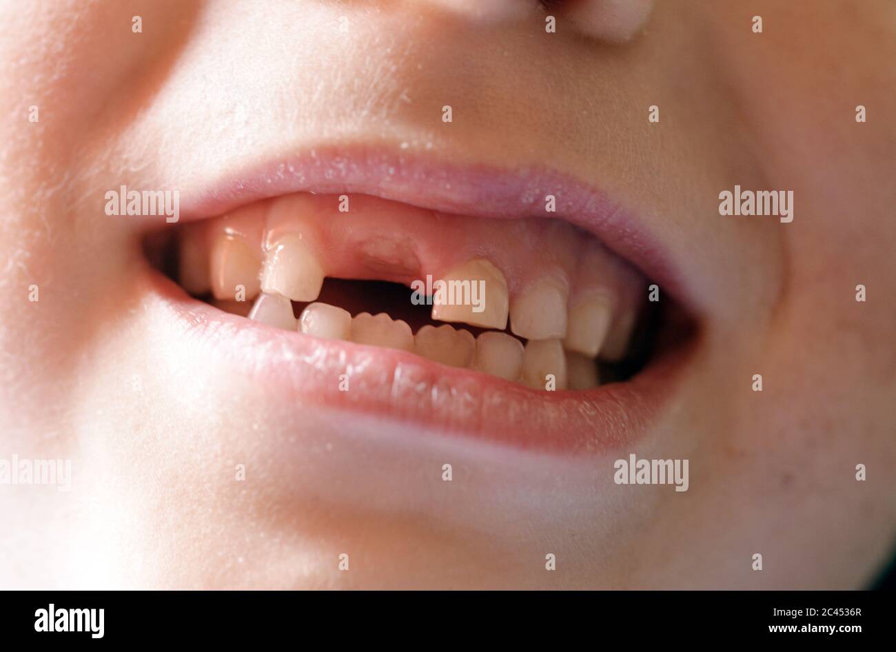 laughing boy with a tooth gap Stock Photo - Alamy