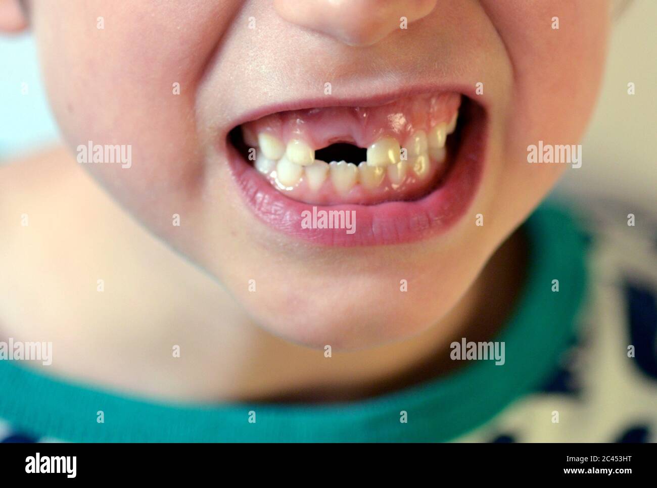 Boy presenting a tooth gap Stock Photo - Alamy