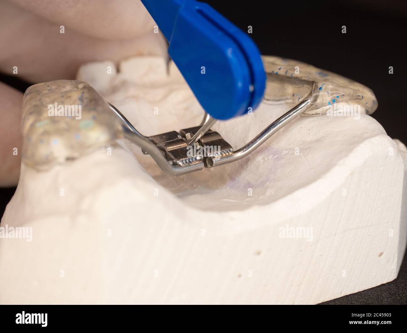 Detail of braces setting. Hyrax expand braces for patient teeth ...