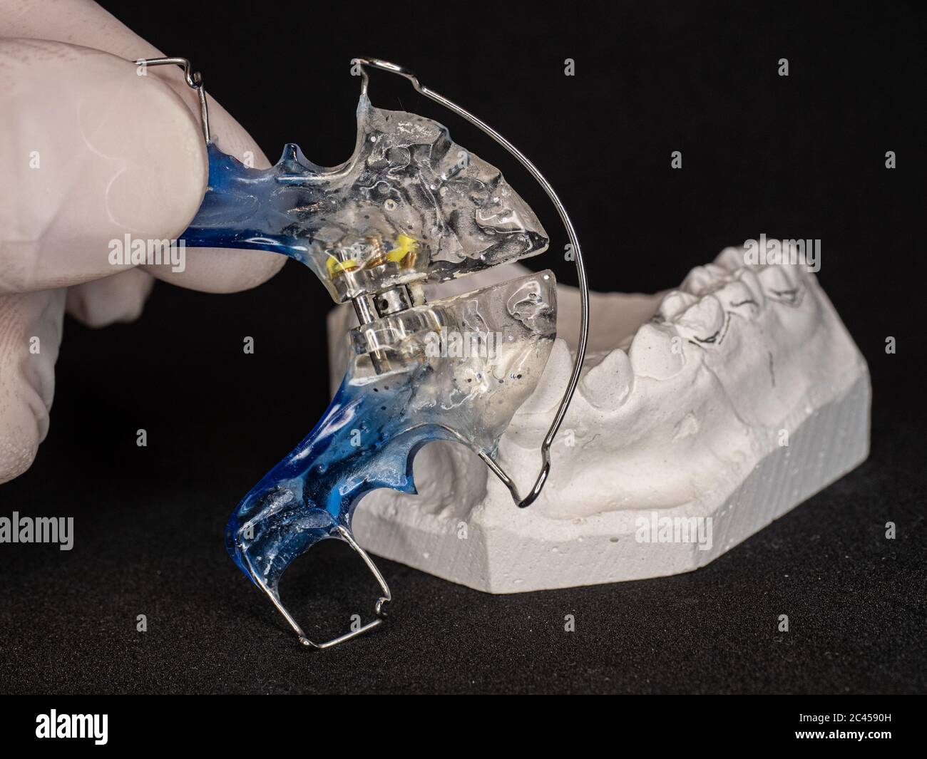 Comparison of blue acrilic tooth retainer for orthodontic correction of ...