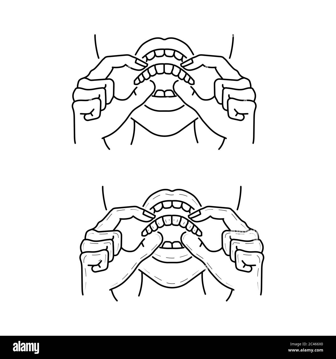 Female undergoing clear aligner treatment vector outline illustration ...