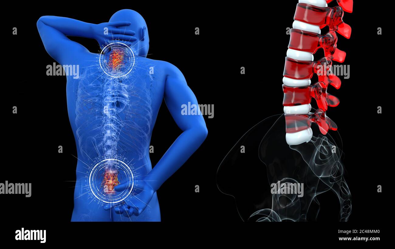 Anatomical vision back pain. Spine anatomy. 3D illustration Stock Photo ...