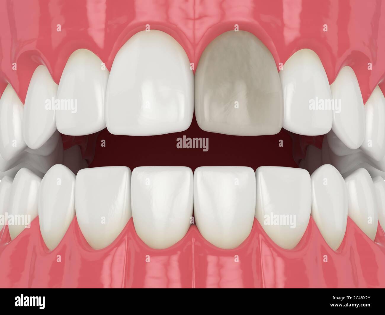 3d render of jaw and upper incisor tooth with dead pulp Stock Photo - Alamy