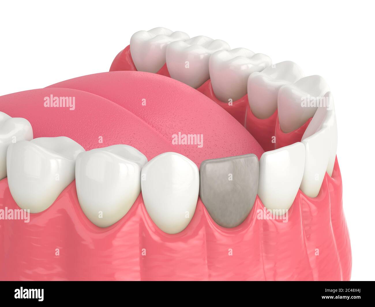 Dead tooth extraction hi-res stock photography and images - Alamy