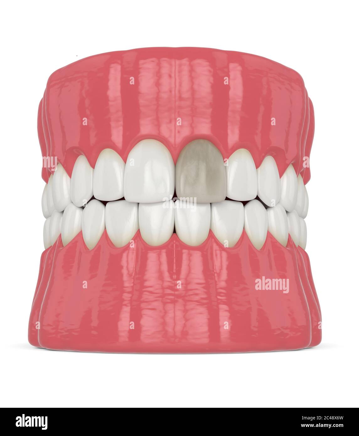 Dead tooth extraction hi-res stock photography and images - Alamy