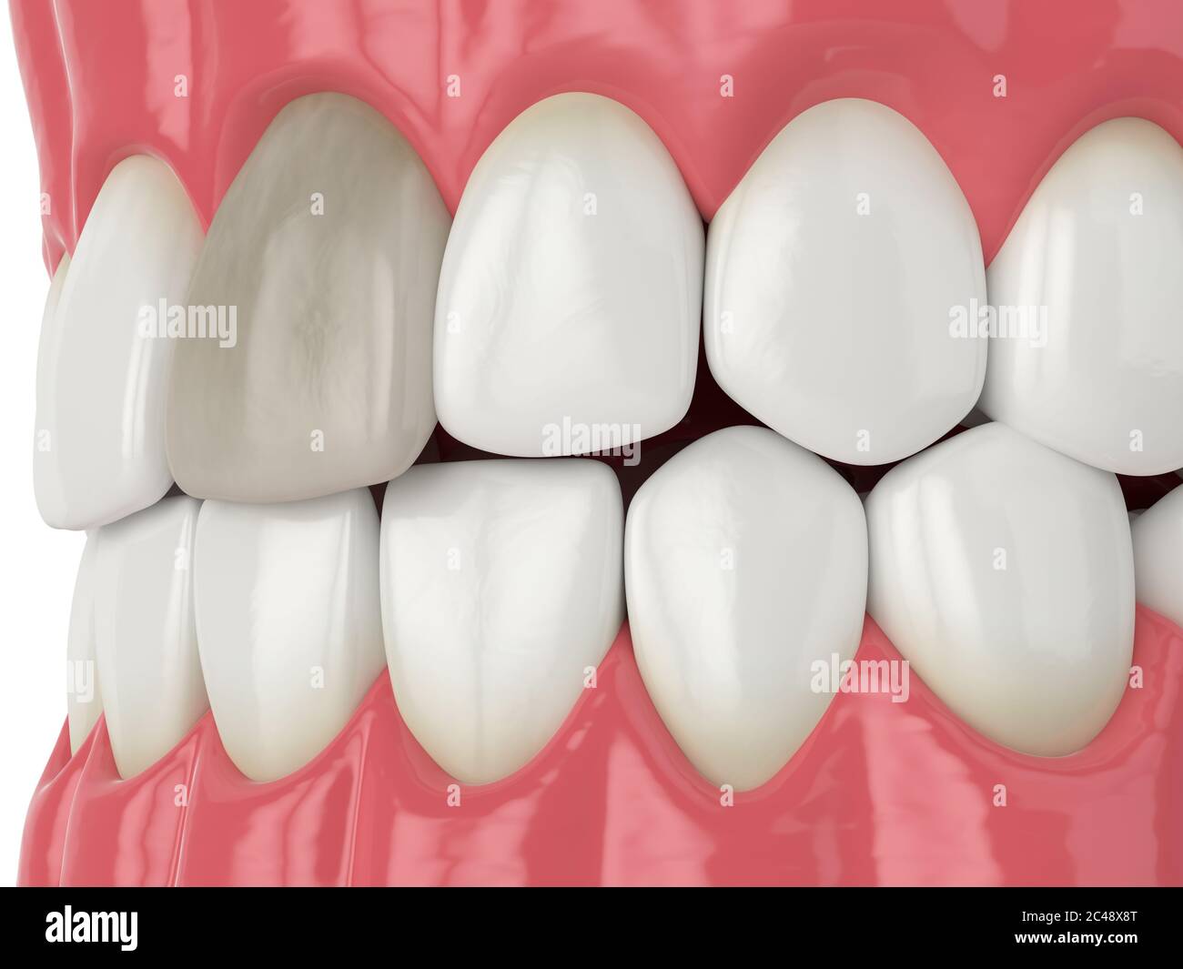 3d render of jaw and upper incisor tooth with dead pulp Stock Photo - Alamy