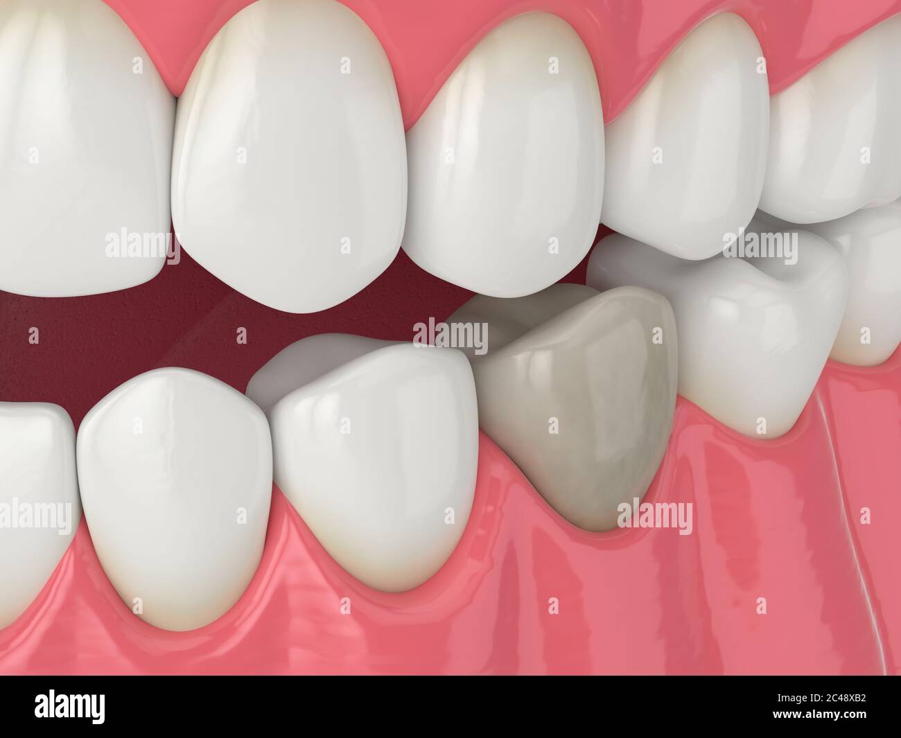 3d render of jaw and lower premolar tooth with dead pulp Stock Photo ...