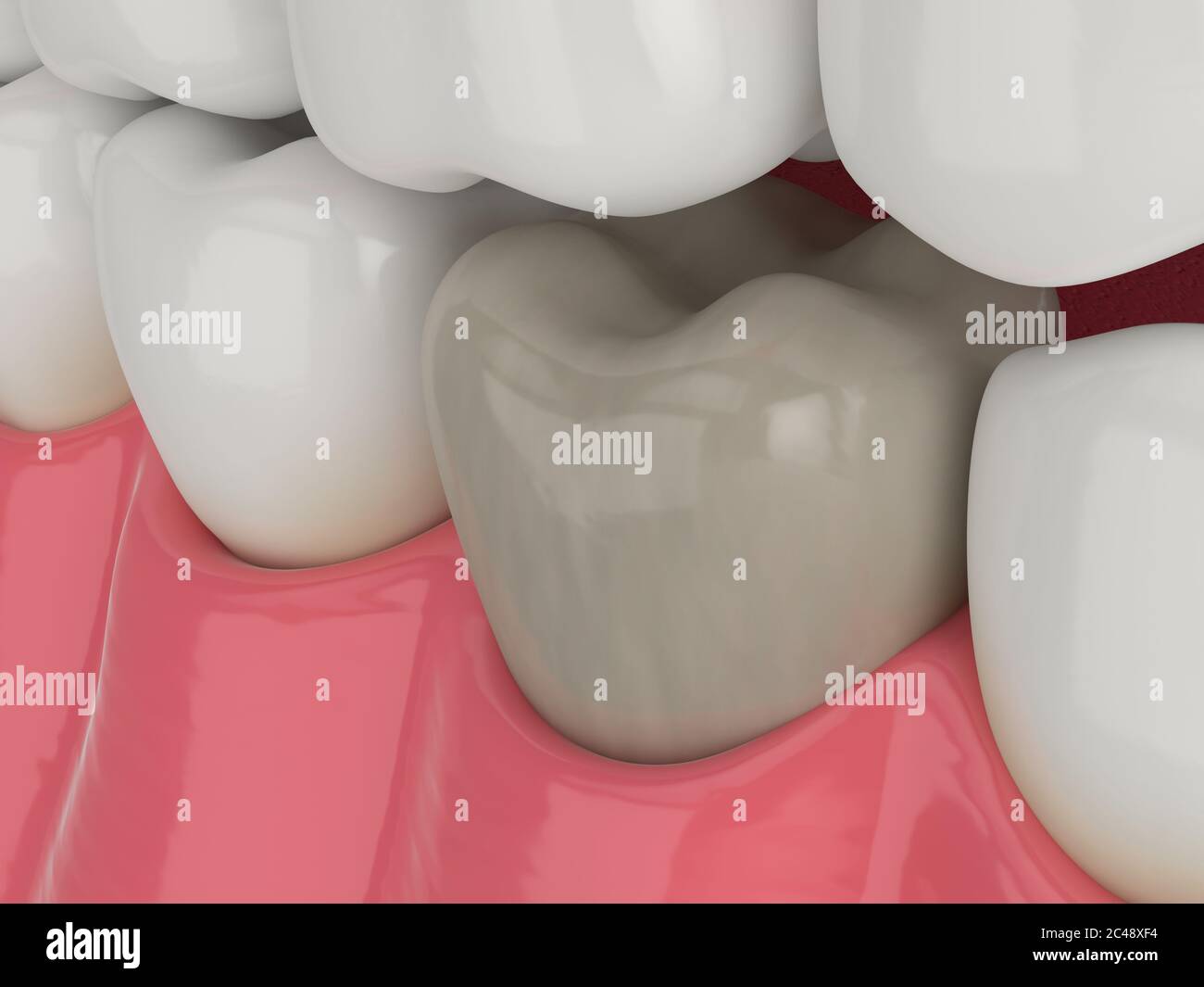 3d render of jaw and lower molar tooth with dead pulp Stock Photo - Alamy
