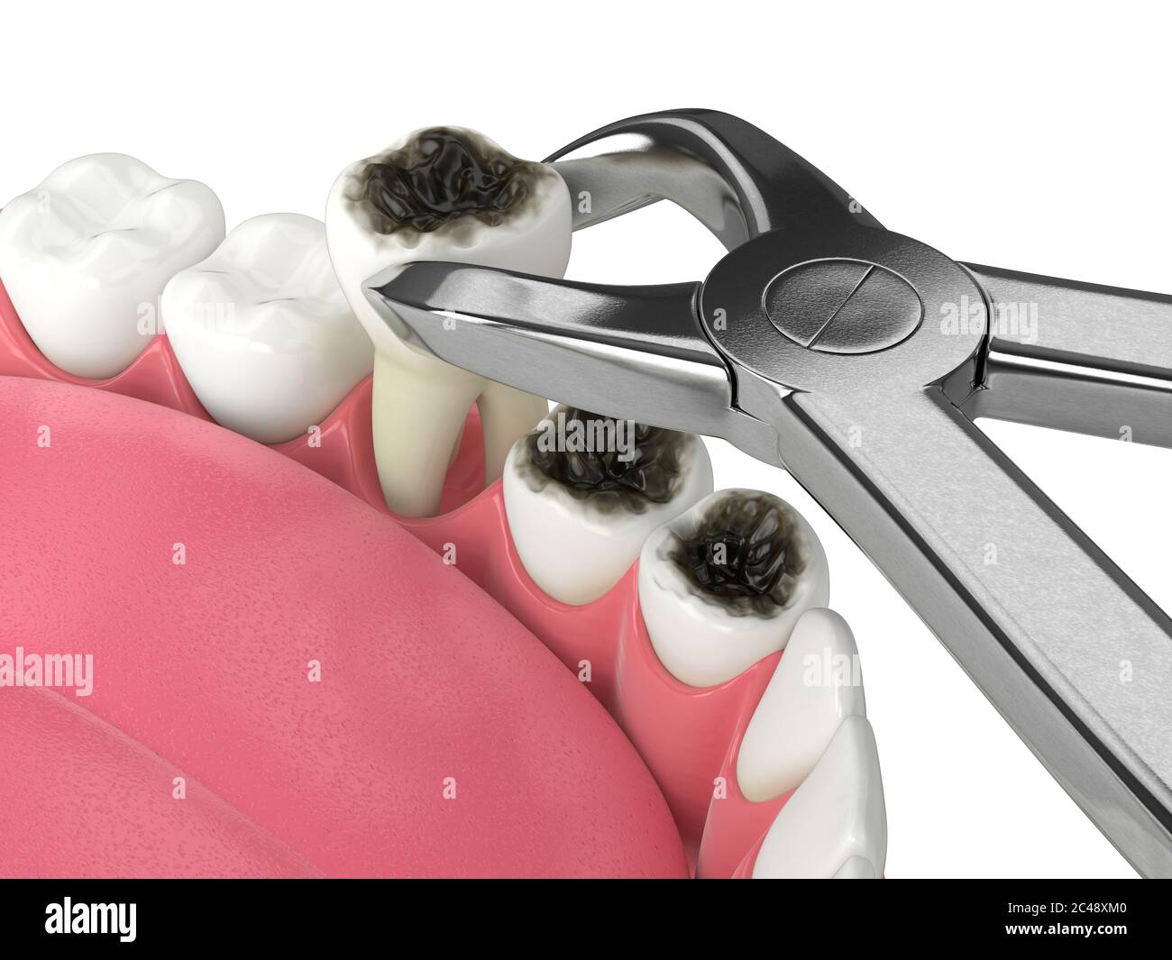 3d render of lower jaw with tooth extracted by dental forceps over ...