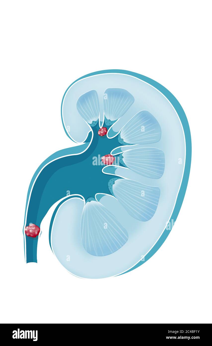 Kidney stone, urolithiasis, lithiasis disease. Kidney stone is a ...