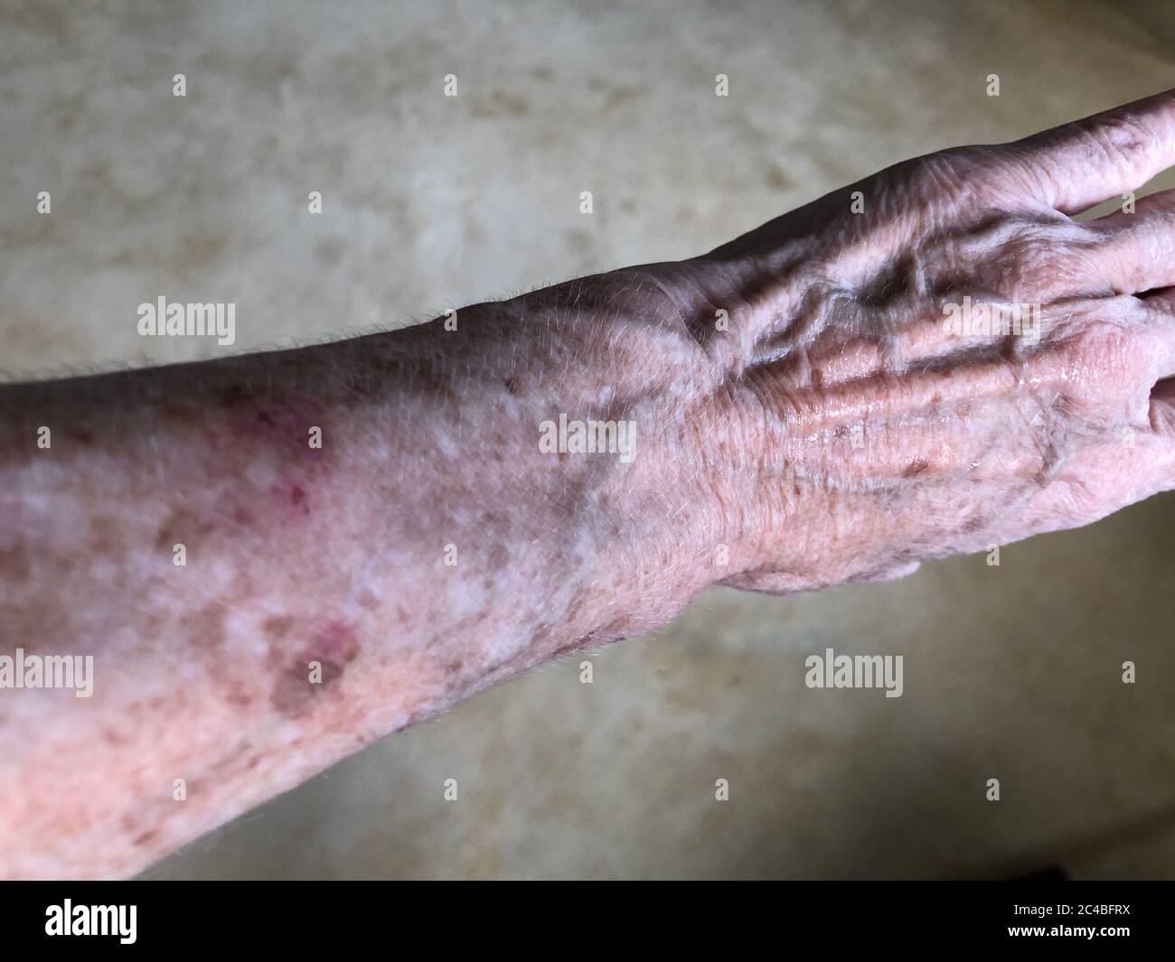 Age spots on the forearm and the hand of a 72-year-old woman Stock ...