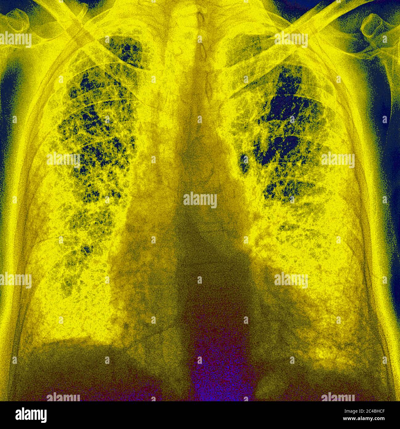 Fibrosis High Resolution Stock Photography and Images - Alamy