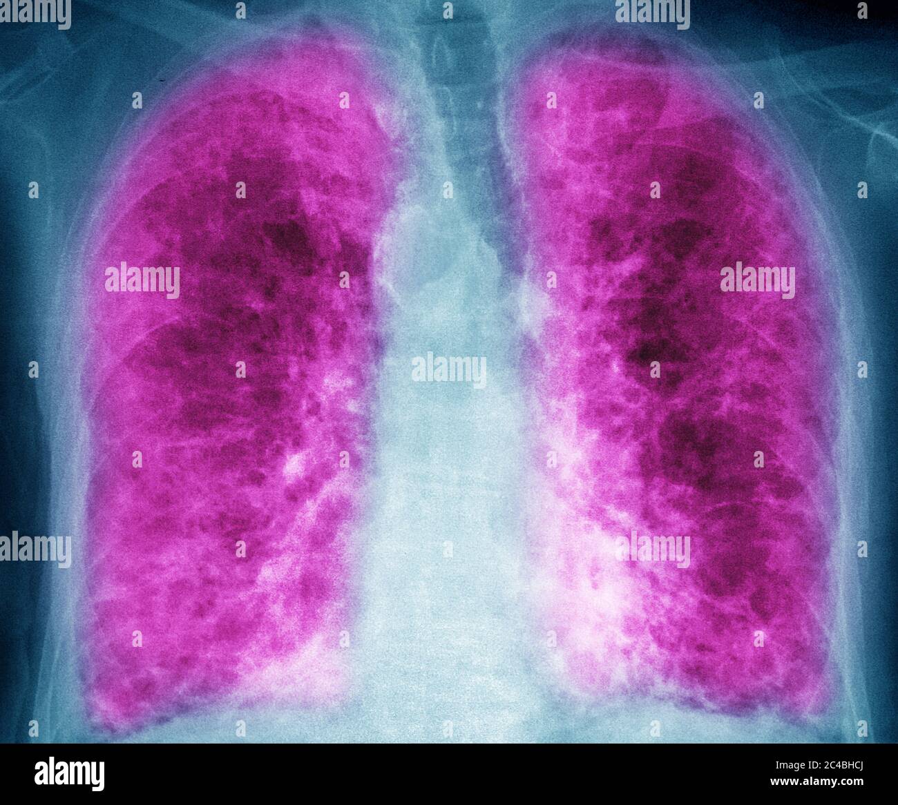Fibrose pulmonaire (lésion des poumons caractérisée par la présence d ...