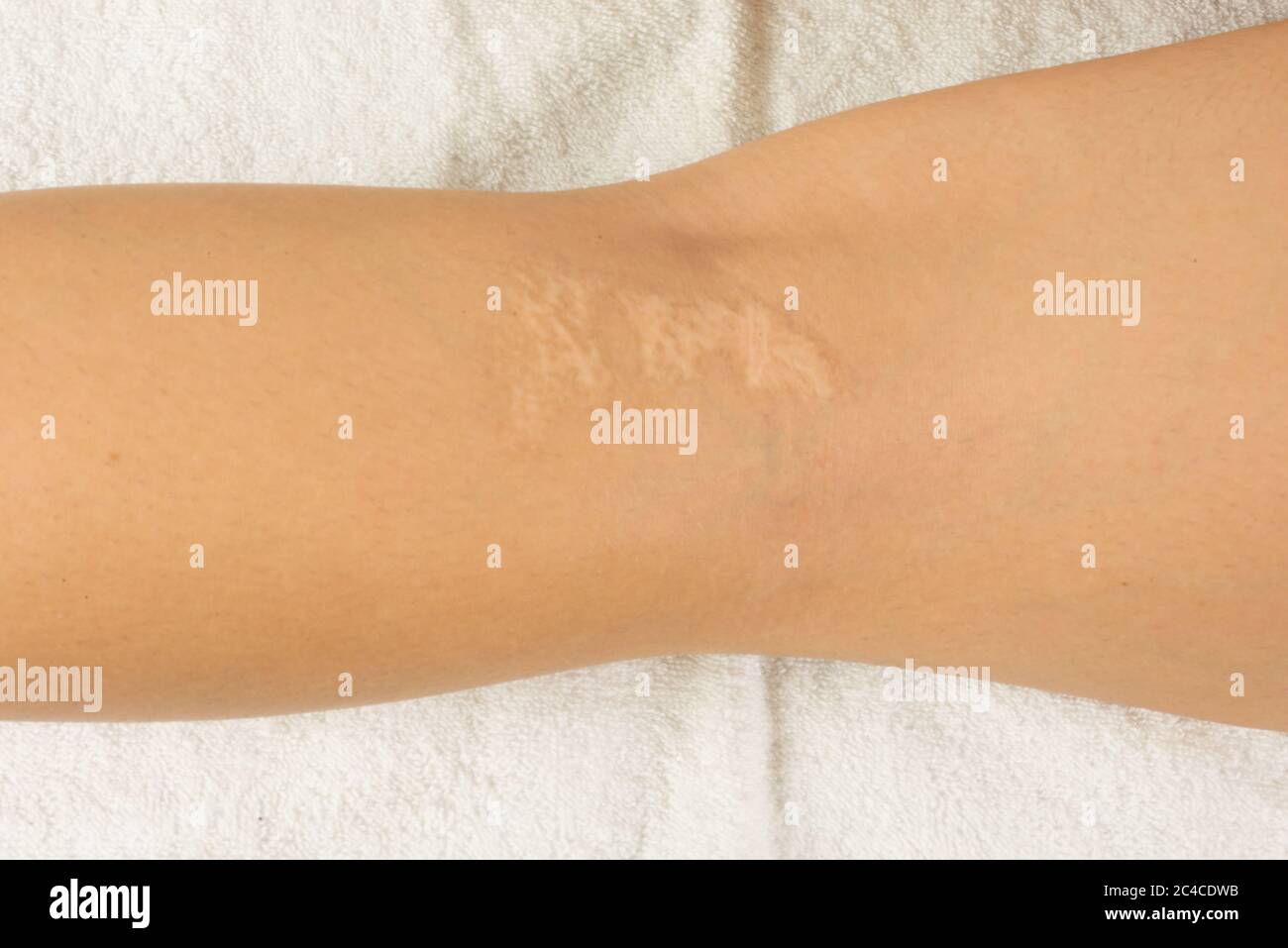 Scars on leg hi-res stock photography and images - Alamy