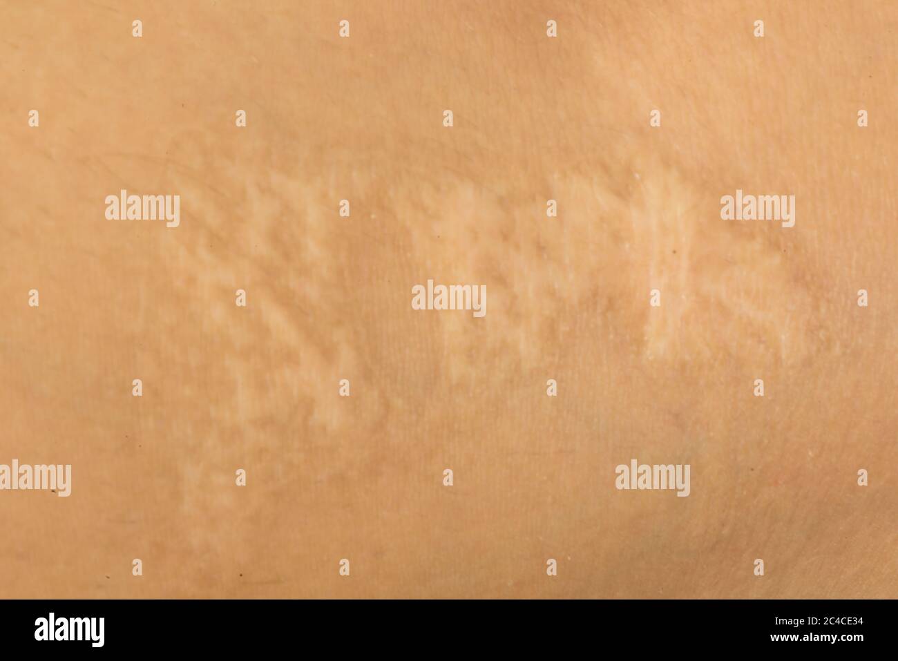 Scar on leg hi-res stock photography and images - Alamy